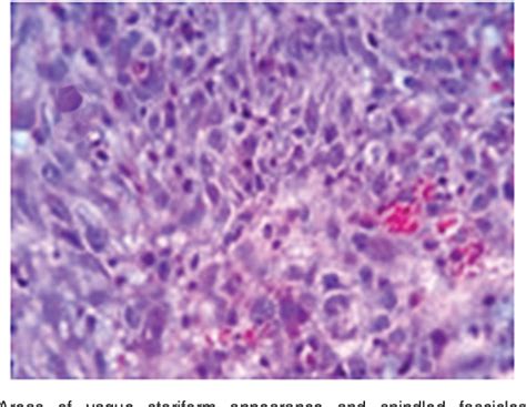 Figure 3 From Undifferentiated Pleomorphic Sarcoma Malignant Fibrous