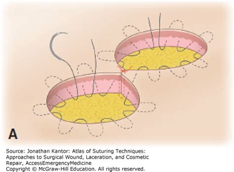 The Figure 8 Double Purse String Suture Anesthesia Key
