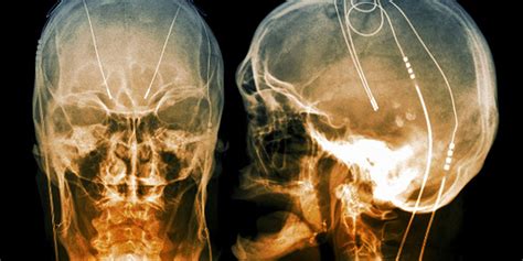 How Do Neural Implants Work Ieee Spectrum