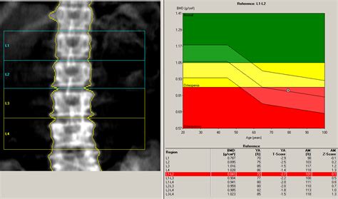 Bone Densitometry Robin K Dore Md Inc