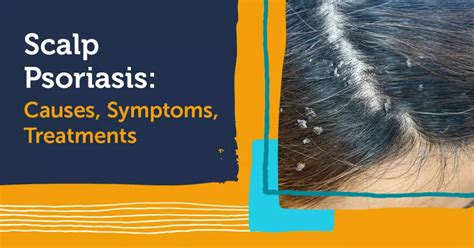 Risk Factors And Precautions For Scalp Psoriasis Ask The Nurse Expert