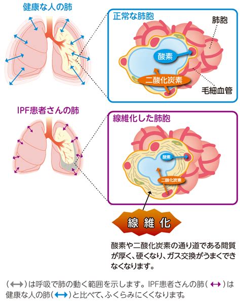 特発性間質性肺炎 特発性肺線維症 2021年1月｜プン