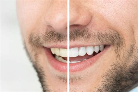 Why In Office Teeth Lightening Deserves The Price Tompkins Dental
