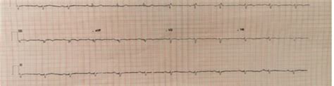 A 12 Lead Ecg Taken On First Admission Sinus Rhythm With St Segment