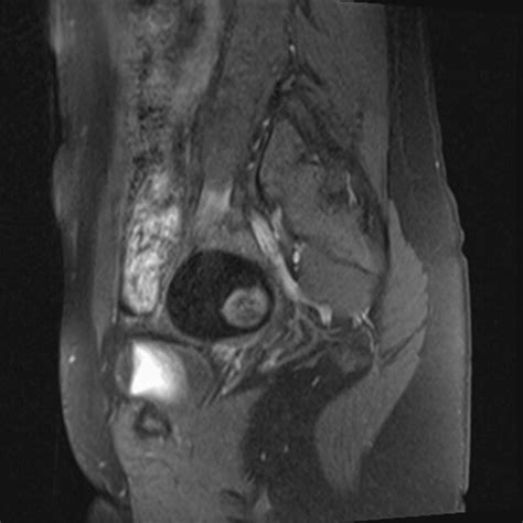 Mature Ovarian Teratoma With Numerous Floating Balls Visualized By