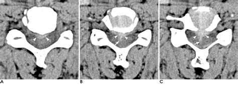 Figure 2 From Intradural Cervical Disc Herniation A Case Report