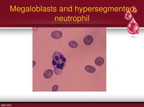 Ppt Anaemia Powerpoint Presentation Free Download Id 9421020