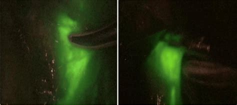 Sentinel Lymph Node Biopsy By Indocyanine Green And Infrared Light