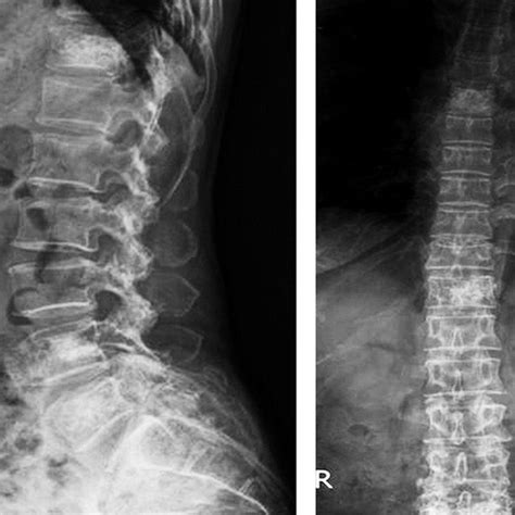 Postoperative Anteroposterior A And Lateral B Radiographs Of A