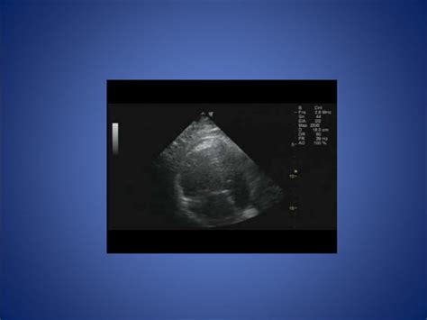 Massive Pulmonary Embolism Case Presentation Ppt