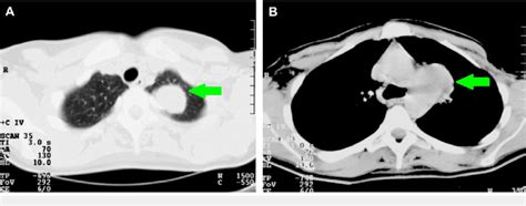 Axial Computed Tomography Ct Scan In January 1996 Pre Treatment