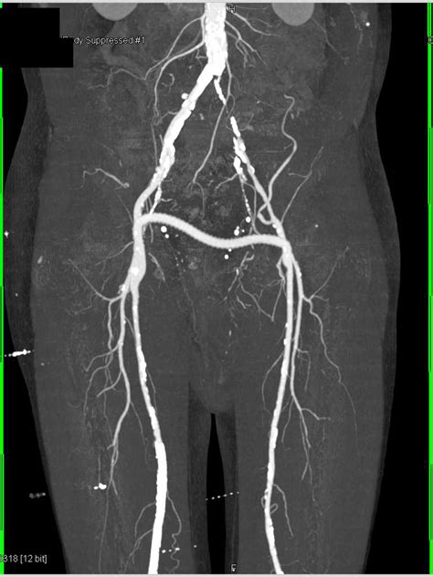 Fem Fem Bypass Graft With Right Iliac Artery Occlusio