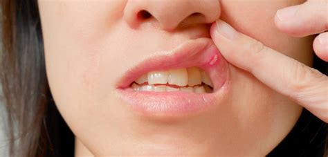 Home Remedies To Treat Mouth Ulcers Here Are Our Top 5 Tips