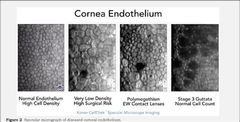 Correlation Between Corneal Endothelial Cell Characteristics And Dry
