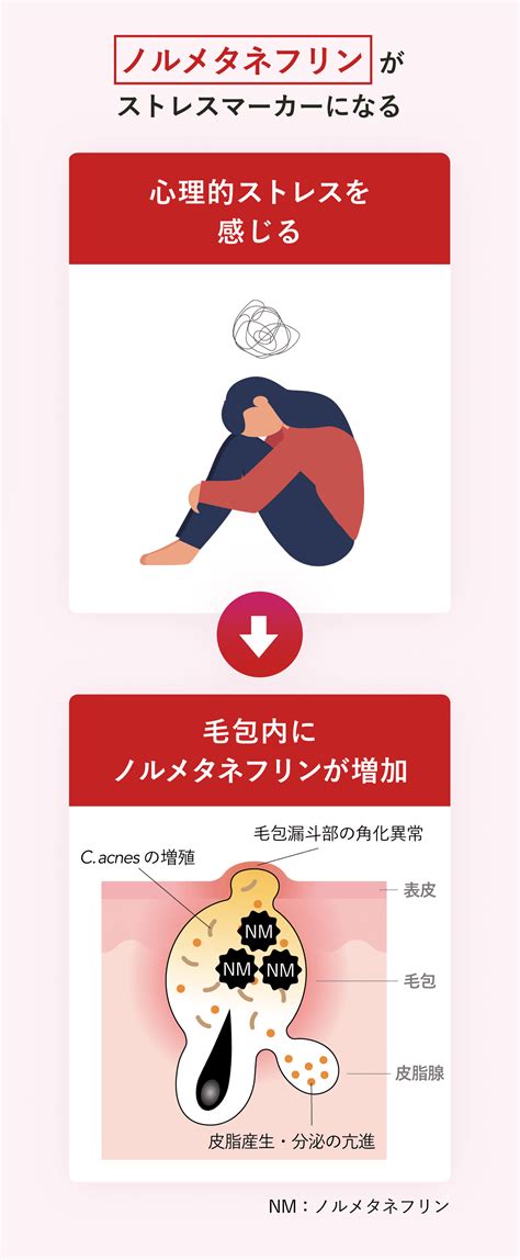 なぜストレスでニキビが増えるのか？毛包内の研究で科学的に証明！【東京薬科大学・佐藤教授】 Wellulu