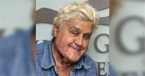 Jay Leno Shows Off Face And Body Scars As Hes Discharged From Burn