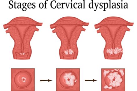 Cervical Dysplasia Facts Causes Symptoms Complications
