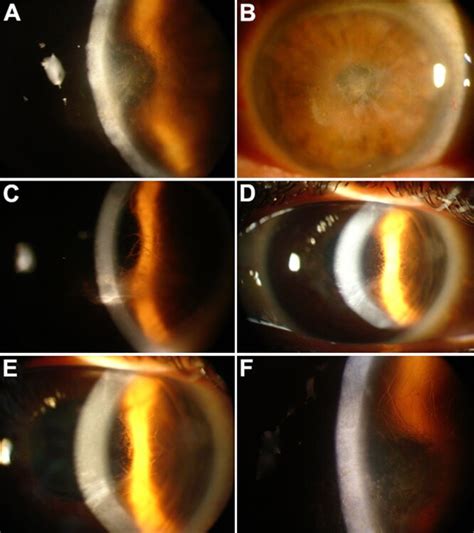 Corneal Phenotype Analyzed By Slit Lamp Examination Slit Lamp