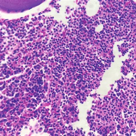Bone Marrow Biopsy Showing Hypercellular Marrow With Diffuse