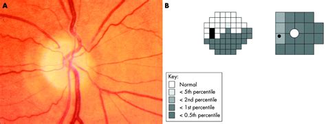 frequency doubling technology perimetry in non arteritic ischaemic