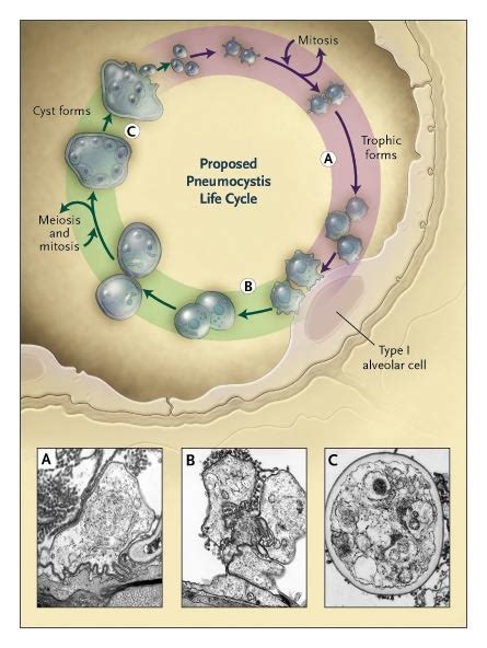 Pneumocystis Pneumonia Nejm