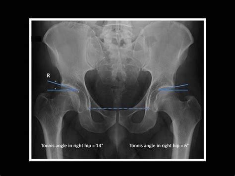 Tönnis Angle Aka Acetabular Roof Angle Angle Or Acetabular Index