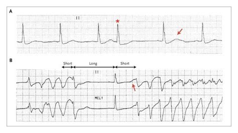 Drug Induced Prolongation Of The Qt Interval Nejm