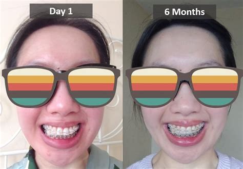 6 Month Update Overjet Unilateral Crossbite Uneven And Lopsided
