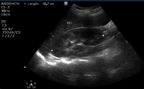 Abdominal Ultrasound With Heterogeneous Contents In The Uterine Cavity