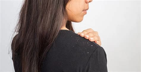 Does Dandruff Cause Hair Fall Malay Mehta Aesthetics Clinic