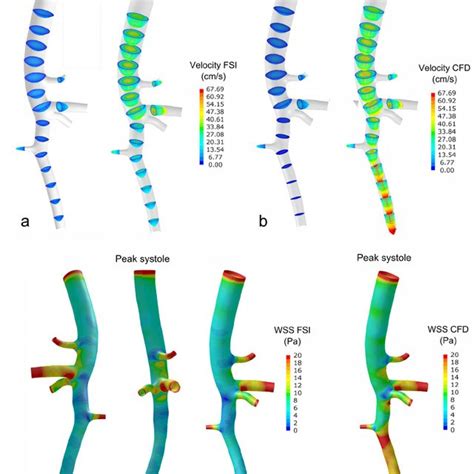 Qualitative Comparison Of Velocity And Wall Shear Stress Between Fsi