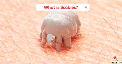 Bed Bugs Vs Scabies 5 Key Differences And Similarities With Easy