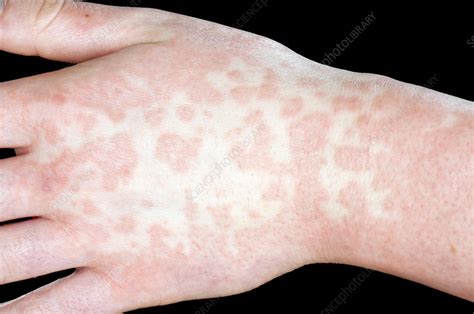 Epstein Barr Virus Infection Stock Image C025 9599 Science Photo
