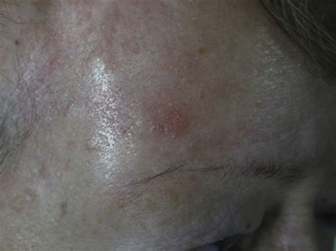 A Classical Dermoscopic Vascular Pattern In An Uncommon Location