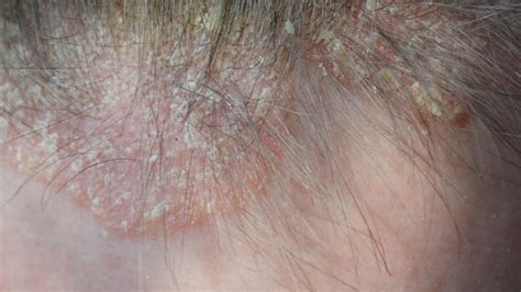 Scalp Eczema Psoriasis Differences Pictures And Treatment 42 Off