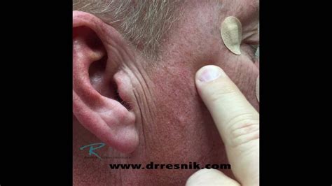 Treatment Of Actinic Keratosis Wth Liquid Nitrogen 1 Youtube