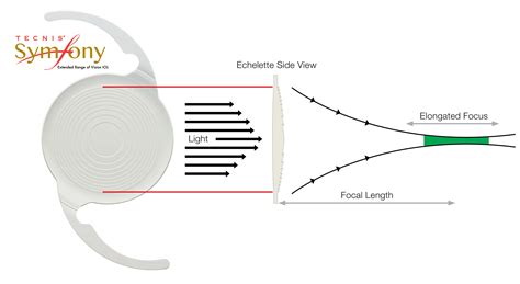tecnis symfony a new step forward in cataract surgery another first