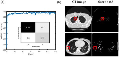 Life Free Full Text Pulmonary Nodule Detection And Classification