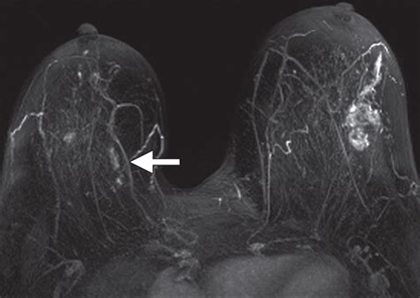 Us Appearance Of Ductal Carcinoma In Situ Radiographics