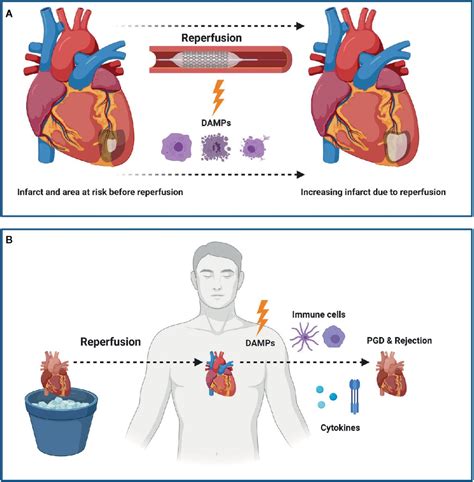 Understanding Myocardial Infarction Signs Symptoms And Treatments To