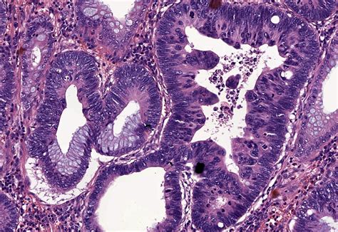 Pathology Outlines Tubulovillous Villous Adenoma