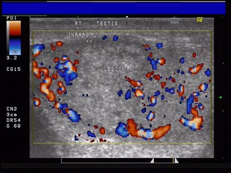 Sono Digest Segmental Testicular Infarct