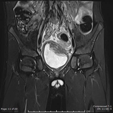 Infected Urachal Cyst With Urachal Sigmoid Fistula Image