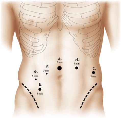 Standardized And Simplified Robot Assisted Superextended Pelvic Lymph