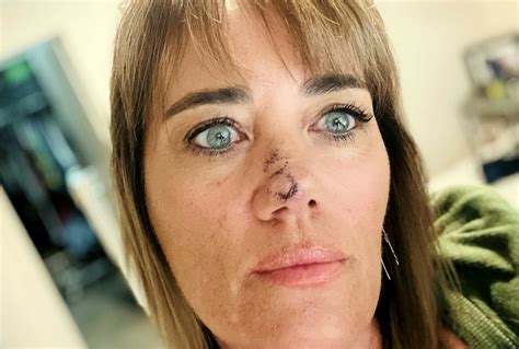 Im 52 And Thought I Was Too Old For Zits But Squeezing It Led To The