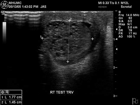 Cystic Dysplasia Of The Rete Testis Journal Of Pediatric Surgery