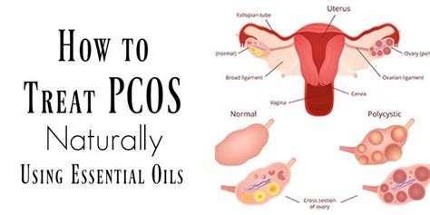 Treat Pcos Naturally Using Essential Oils Theres An Eo For That