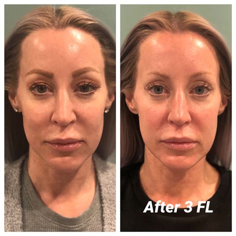 List 94 Pictures Facial Massage Before And After Photos Completed