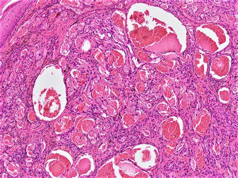 Pathology Outlines Hemangioma And Variants
