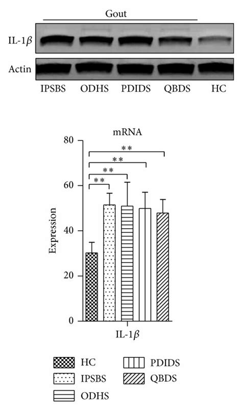 The Mrna Expression Of Il 1β In Pbmcs Of Patients With Pg In Different